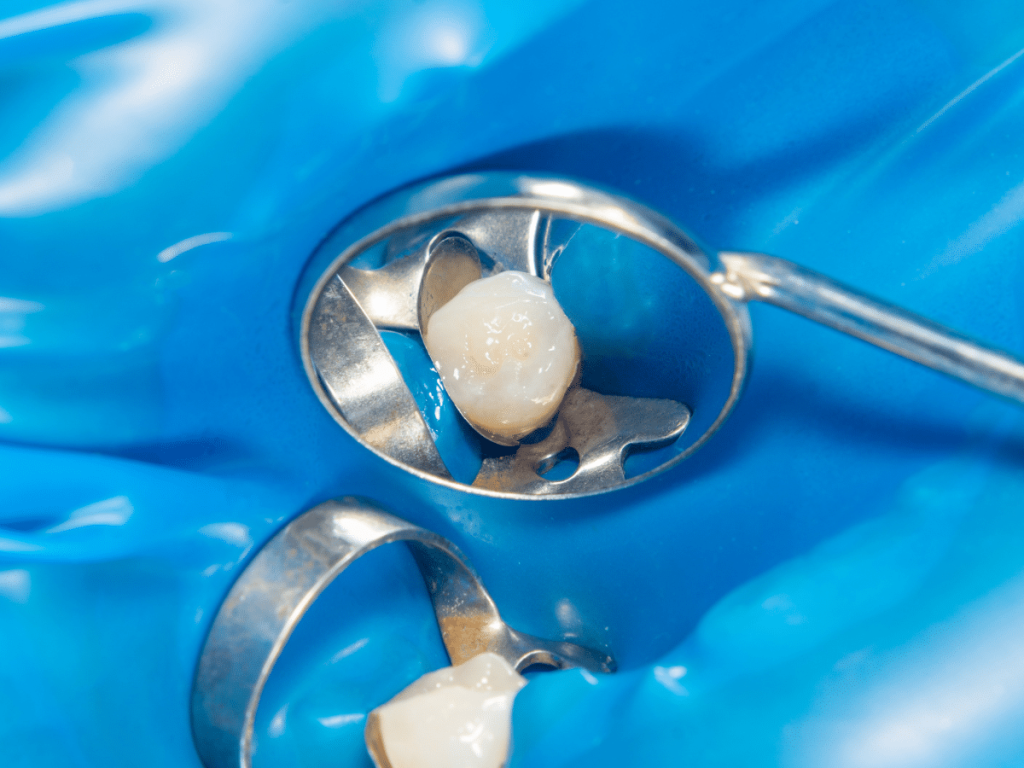 Fluoride Sealant on Teeth – Benefits, Procedure & Long-Term Protection
